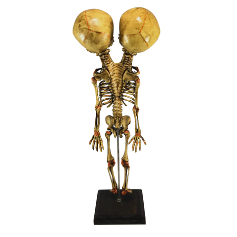 Vintage Deluxe Siamese Twin Skeleton – asylumzone